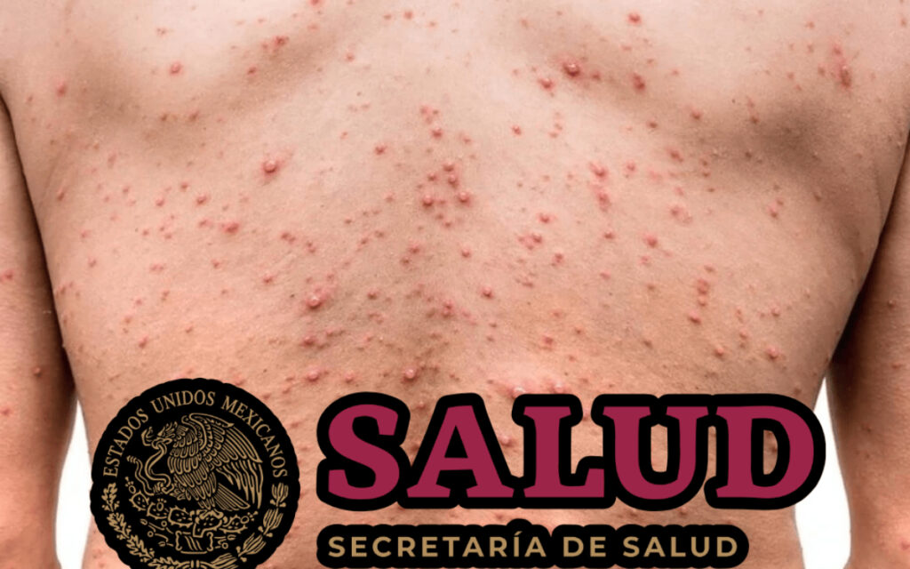 ¿Qué es virus Mpox y cómo se contagia? La enfermedad que ya cobró ...